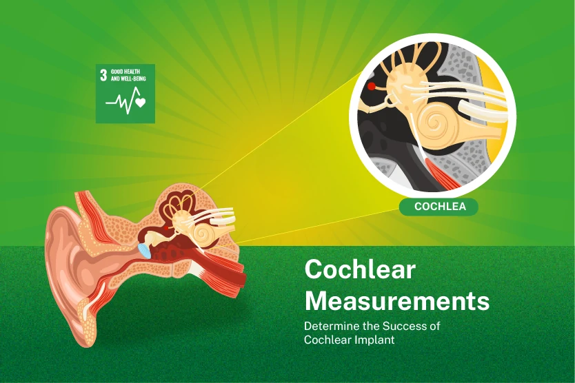 Measurement of the Patient's Cochlea Determines the Success of the ...